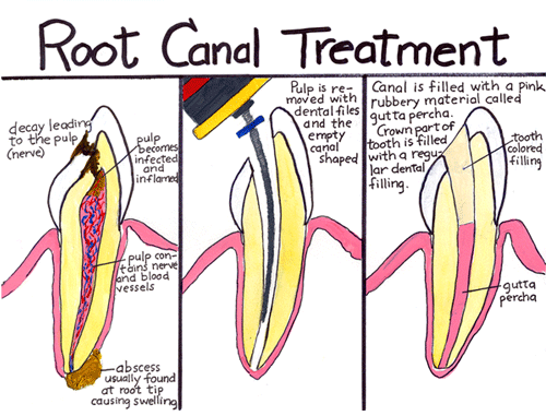 Root Canal | Dentist Greenville SC: Julian Thomas Family & Cosmetic ... Root Canal | Dentist Greenville SC: Julian Thomas Family & Cosmetic ...